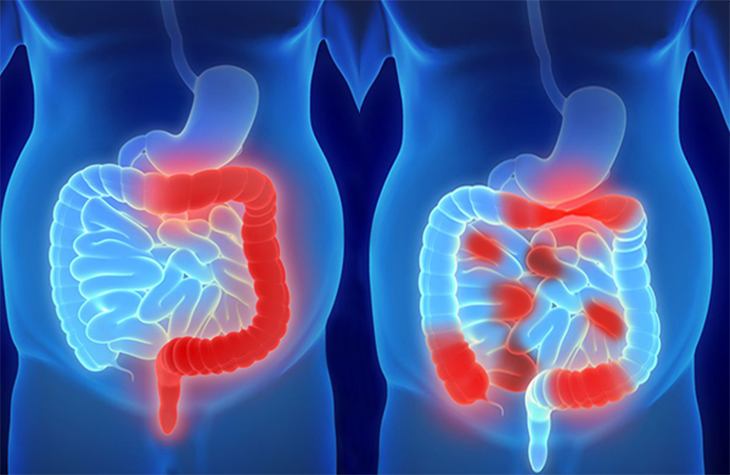 Medical Myths You Need To Know About IBD