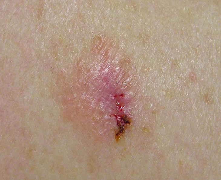 10 Signs Your Moles Are Malignant • Page 3 of 10